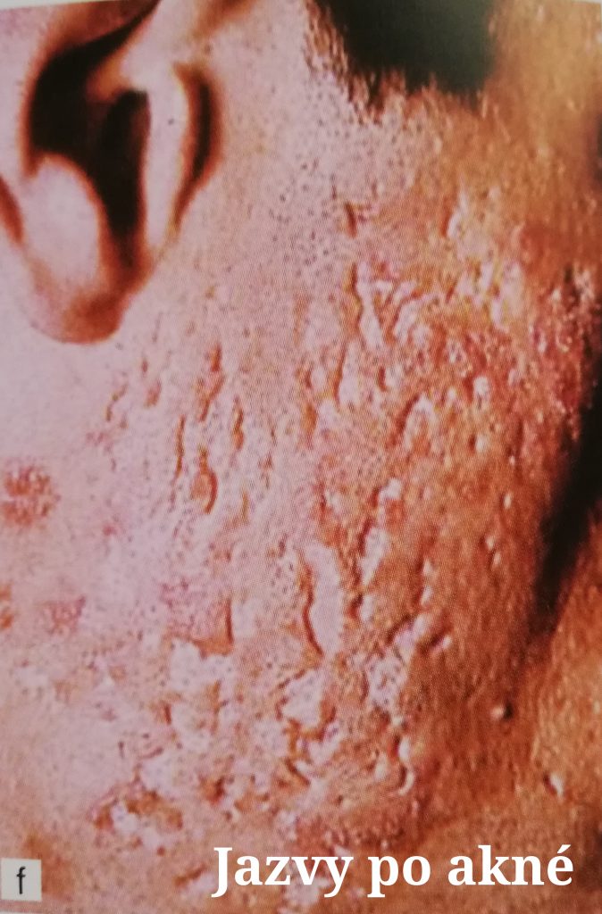 Spoznaj typy a prejavy akné a vyber pre svoju pleť správne ošetrenie ...
